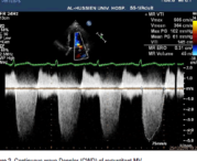 ¡Descubre cómo calcular la regurgitación mitral con EROA en segundos ...