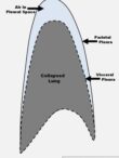 Calculadora de Criterios de Light para Derrame Pleural: ¡Aprende a ...